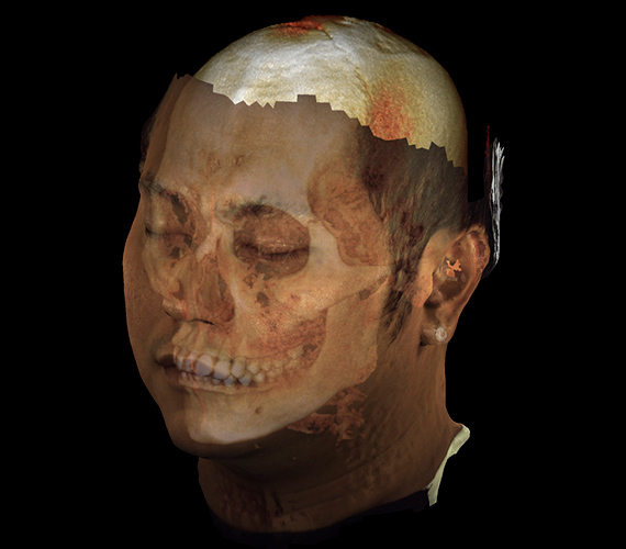 CBCT integrated face photo option | Planmeca ProFace